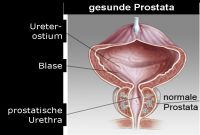 Gutartige Prostatavergrößerung (BPH) ǀ UKD